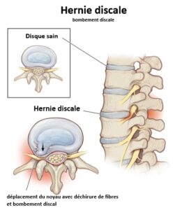 Qu'est-ce qu'une hernie discale ? Symptômes, diagnostic et traitements